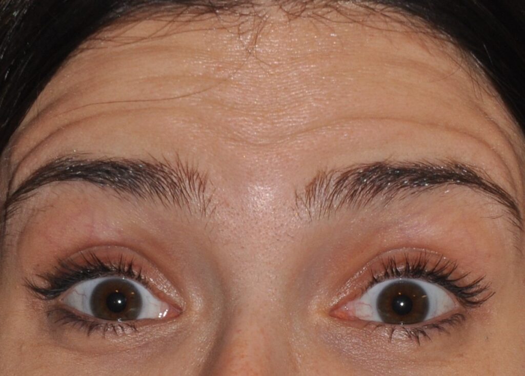 BOTOX® Before and After Photos | Seattle, WA | Amit D. Bhrany, MD