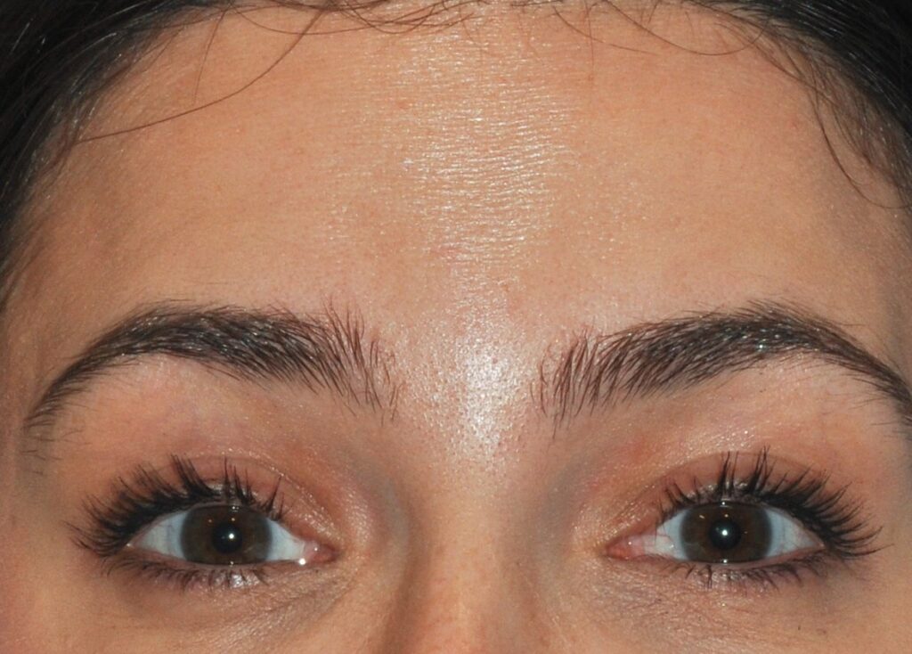 BOTOX® Before and After Photos | Seattle, WA | Amit D. Bhrany, MD