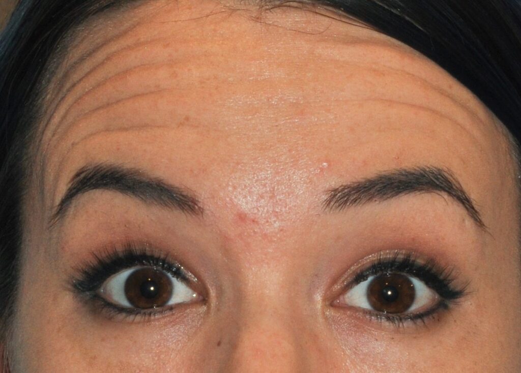 BOTOX In Seattle, WA | Seattle Face & Skin
