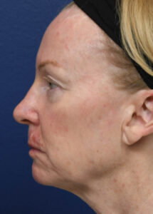 Facial Plastic Surgery In Seattle | Seattle Face & Skin