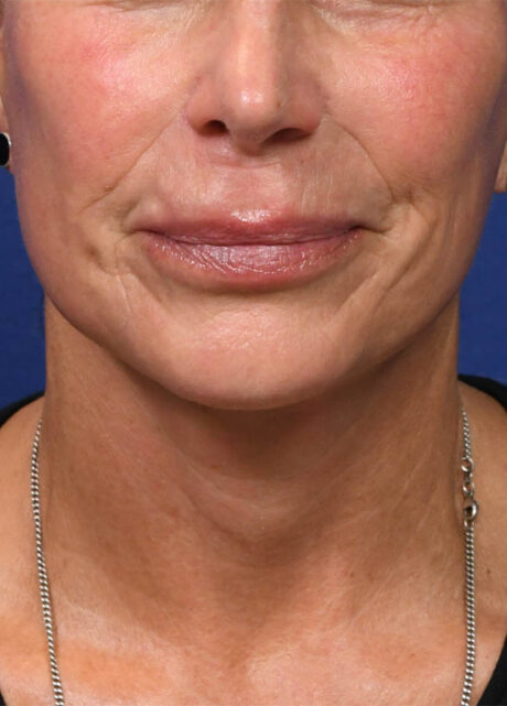 Real Patient Case: 3680 | Seattle, WA | Amit D. Bhrany, MD